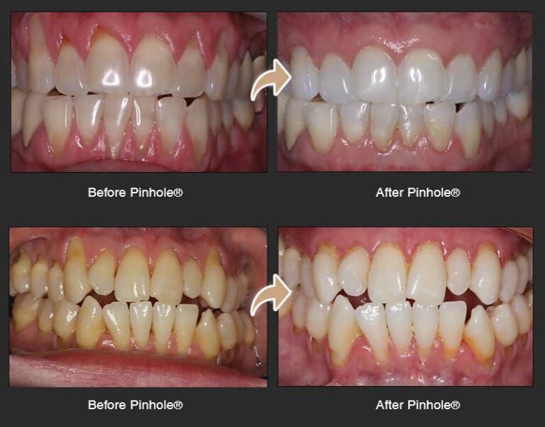Pinhole® Surgical Technique - Alhambra Dental